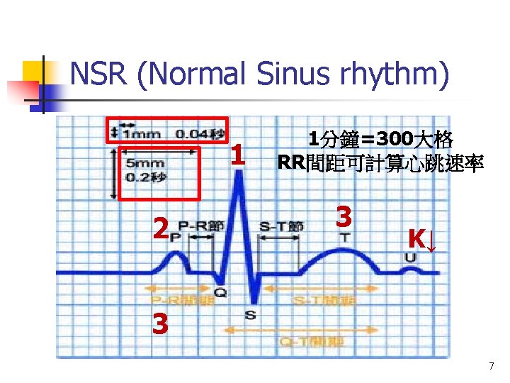NSR Normal Sinus rhythm 1 2 1300 RR
