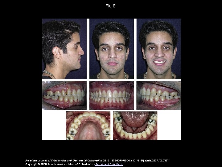 Orthodonticsurgical treatment of Class III malocclusion with extraction