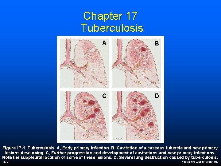 Chapter 17 Tuberculosis A B C D Figure