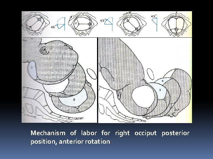 Malposition of the fetal head occipitoposterior position of