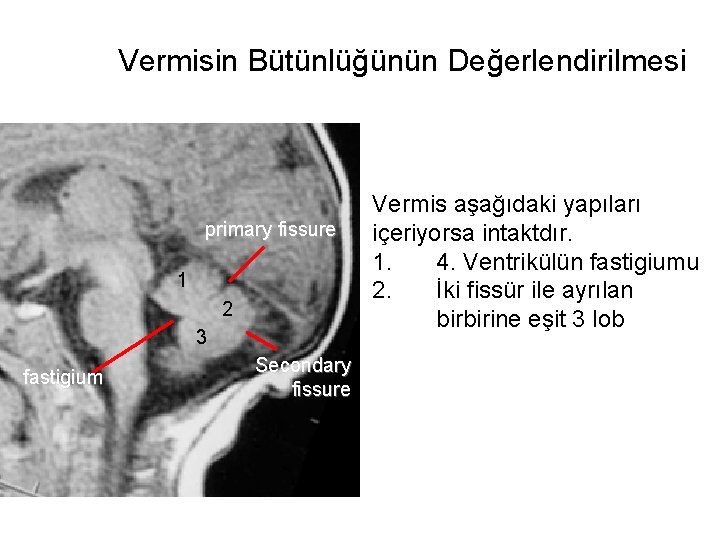 Fetal Posterior Fossa Anomalileri Prof Dr Talat Umut