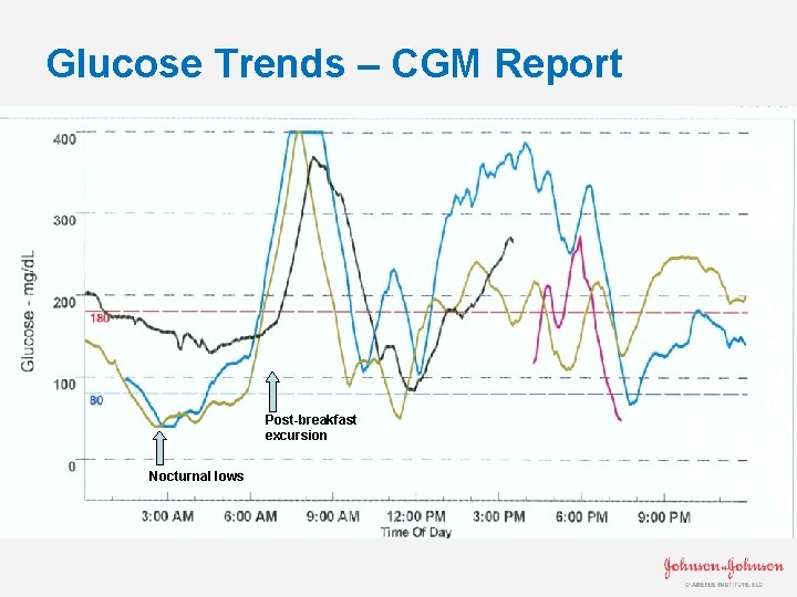 Continuous Glucose Monitoring Diabetes Management Evolution Urine Testing