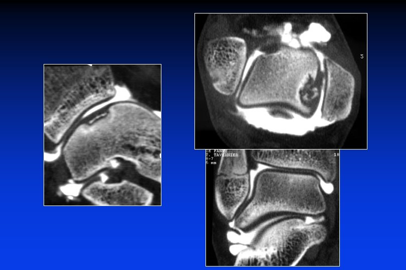 Traumatologa del Tobillo La mortaja y el tendn