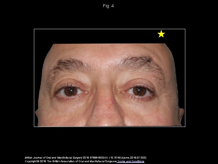 Flattening of the orbital lower eyelid fat as