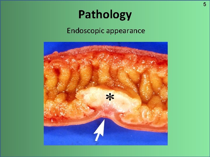 Contemporary Management of Duodenal Carcinoid Tumors diploma work