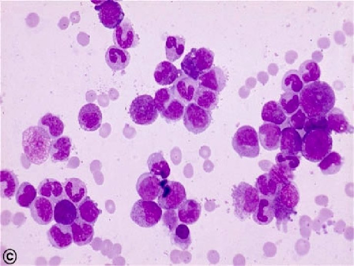 WHO CLASSIFICATION OF MYELOID NEOPLASMS 2000 Chronic myeloproliferative
