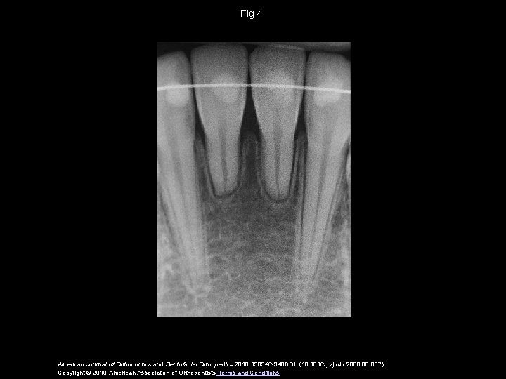 Shortroot anomaly in an orthodontic patient Leandro Silva