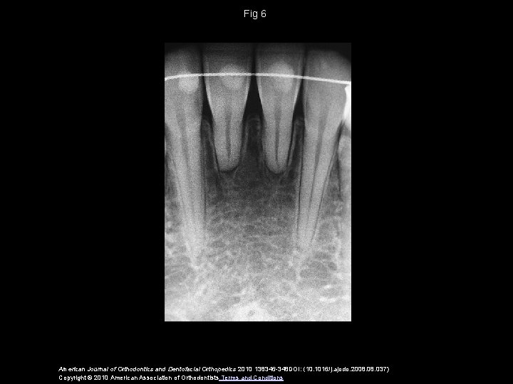 Shortroot anomaly in an orthodontic patient Leandro Silva