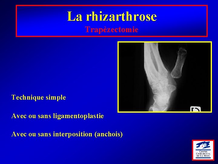Pathologies dgnratives de la main et solutions chirurgicales