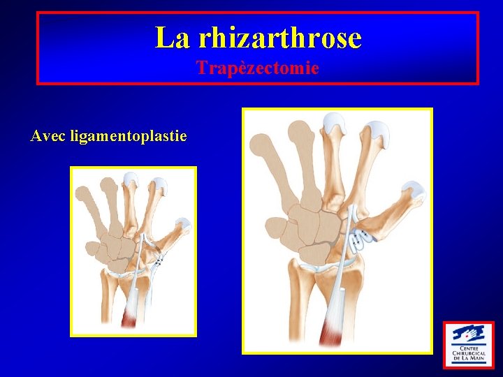 Pathologies dgnratives de la main et solutions chirurgicales