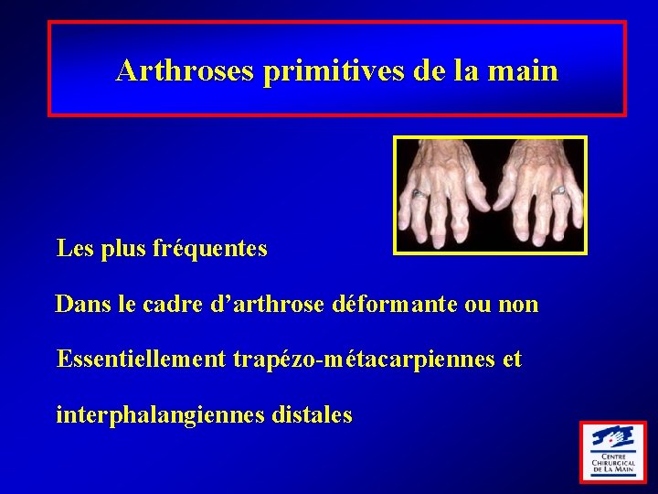 Pathologies dgnratives de la main et solutions chirurgicales