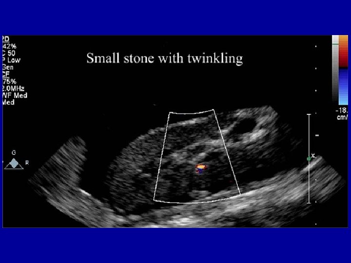 Pediatric Stone Disease Overview Epidemiology 4 Reasons Stones