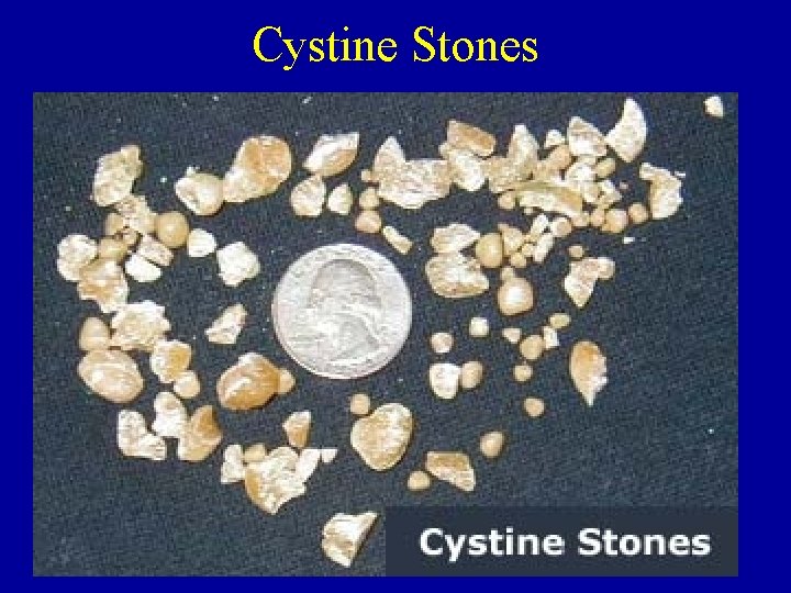 Pediatric Stone Disease Overview Epidemiology 4 Reasons Stones