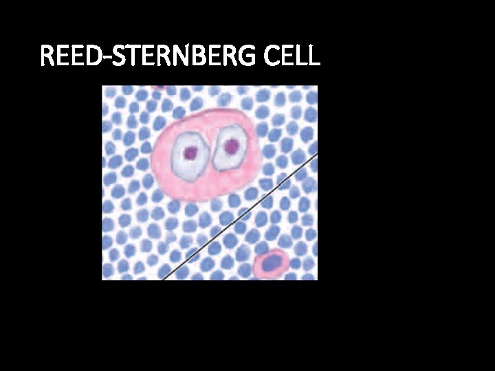 HODGKINS DISEASE HD Dr Bindhusaran M D Hom