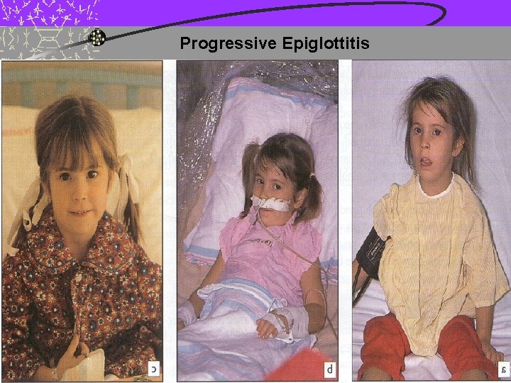 Childrens Respiratory Disorders Epiglottis RSVBronchitis Pneumonia ...