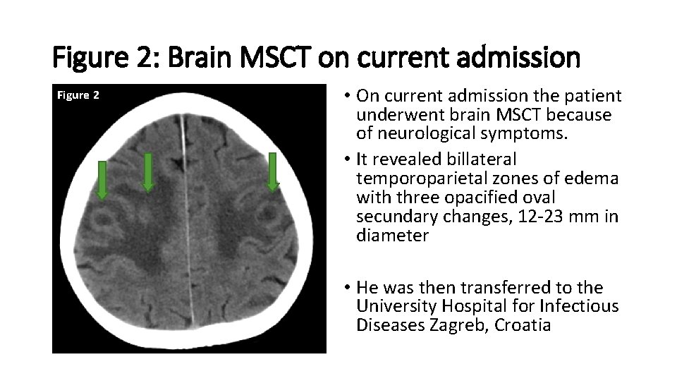 Nocardia brain abscesses Marija Kusulja MD Vladimir Krajinovi