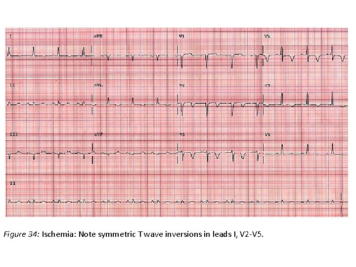 Introduction to ECG Interpretation Electrocardiogram interpretation is an