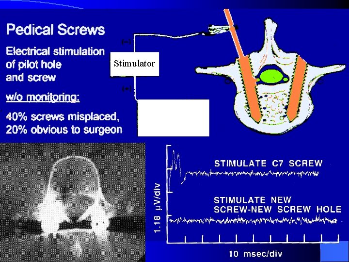 INTRAOPERATIVE NEUROPHYSIOLOGY AND NEUROMONITORING Ramsis F Ghaly MD