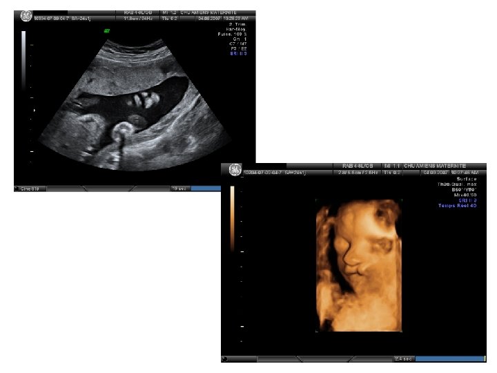 ECHOGRAPHIE EN OBSTETRIQUE IRM FOETALE M BRZAKOWSKI D