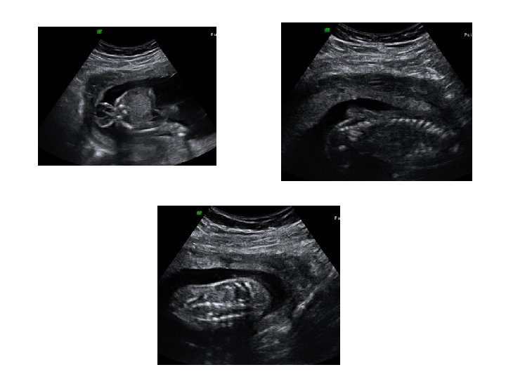 ECHOGRAPHIE EN OBSTETRIQUE IRM FOETALE M BRZAKOWSKI D