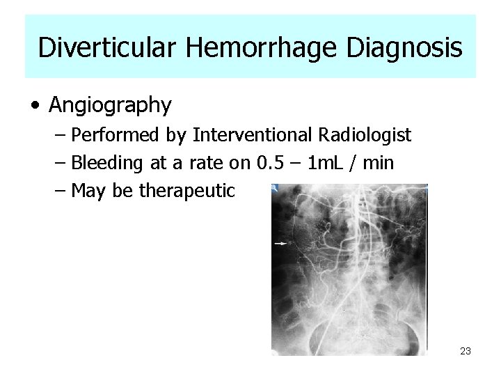 Diverticular Disease and Hemorrhoids Lance T Uradomo MD