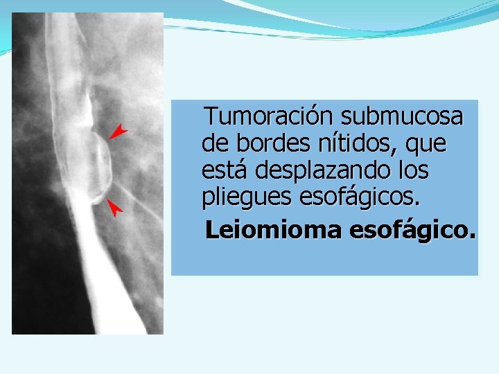 Tumores esofgicos infrecuentes Una revisin de la imagen