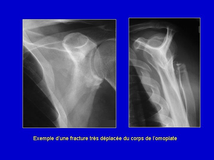 Fractures de lomoplate Fractures de lomoplate 1 Les