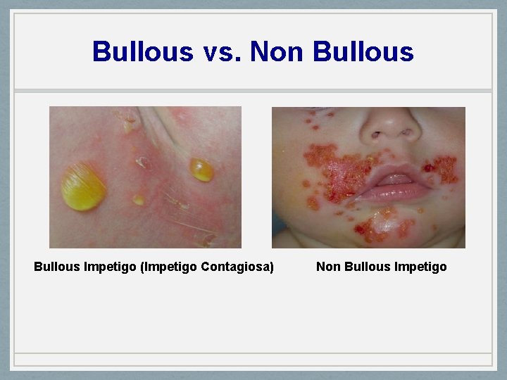 Body Systems Case 1 School Sores Gram stain