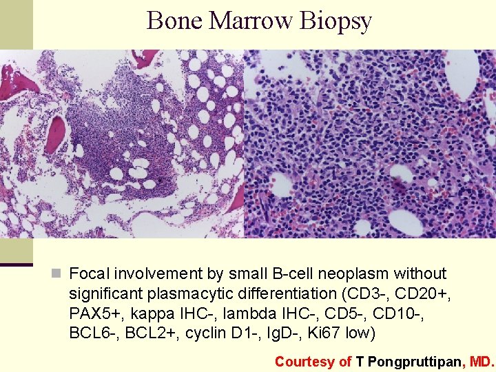 Bone Marrow Biopsy n Focal involvement by small