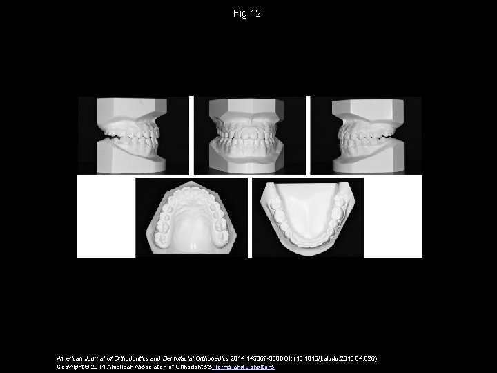 Orthodontic decompensation and correction of skeletal Class III