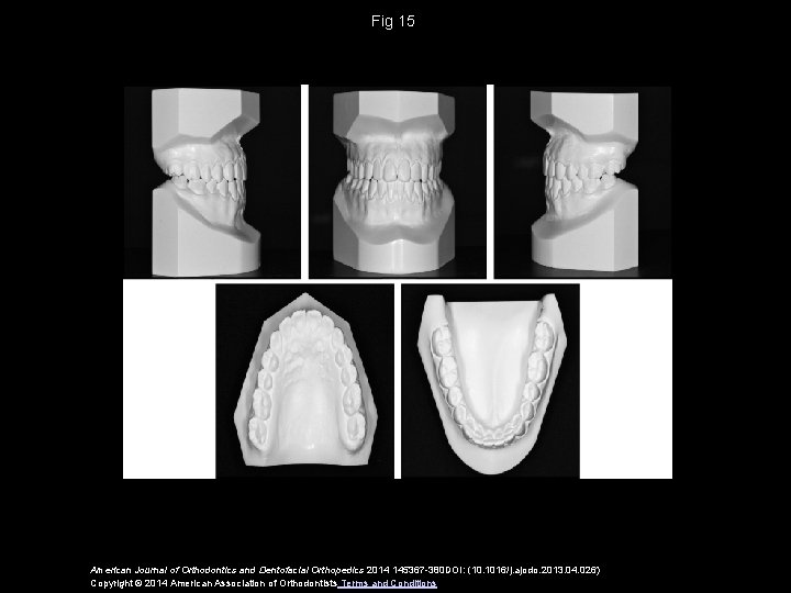 Orthodontic decompensation and correction of skeletal Class III