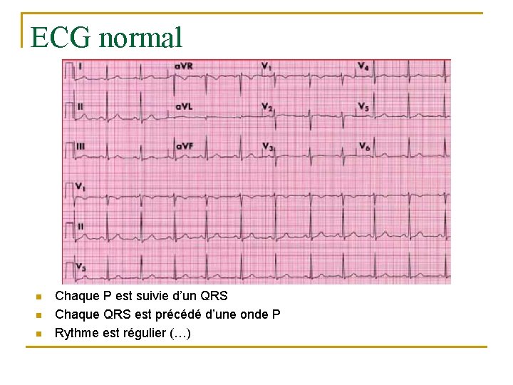Les bases du trac ECG Cours IDEAS maladies