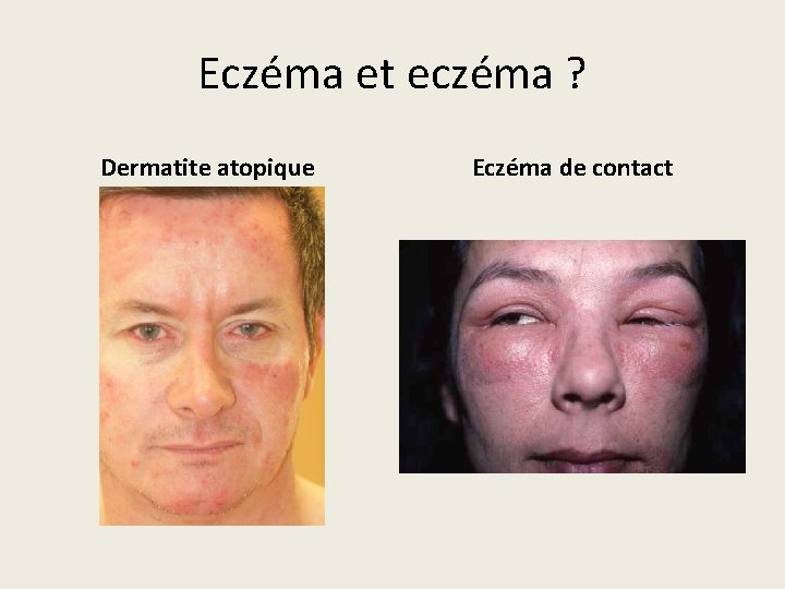 La dermatite atopique et le bb Pourquoi Pourquoi