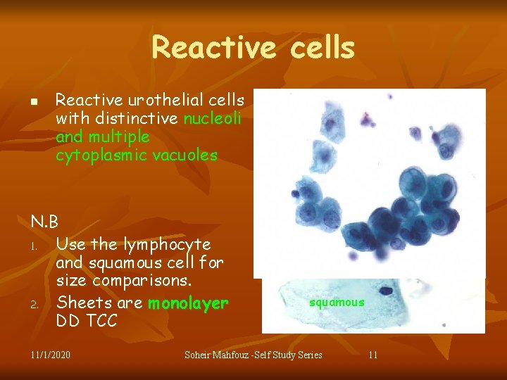 1 Urine Cytology Soheir Mahfouz 2017 NORMAL CELLS
