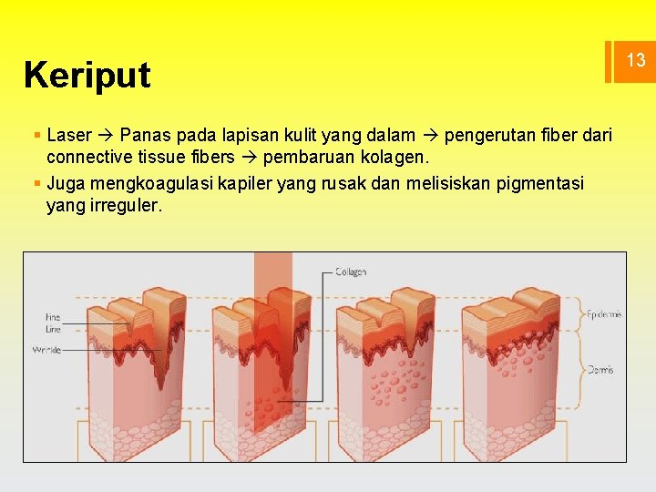 Nd YAG LASER Hastika Saraswati dr Pembimbing Prof