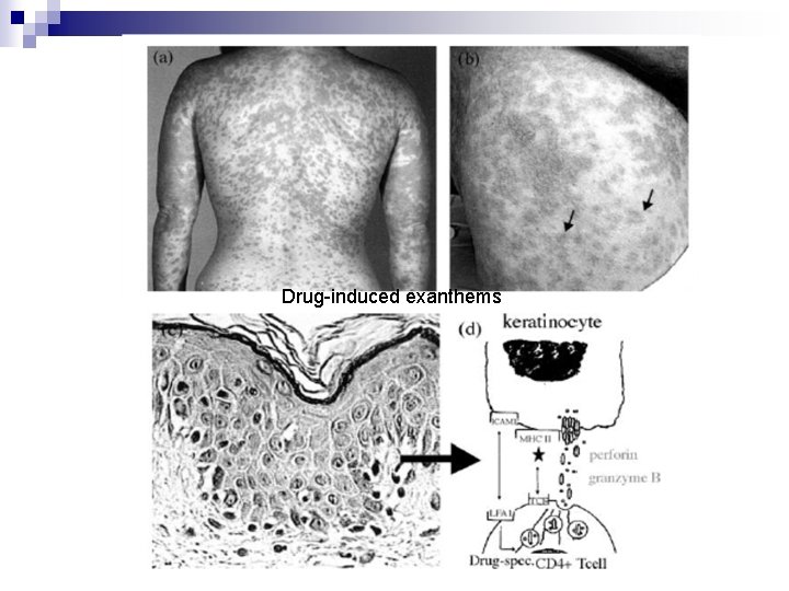 Drug Allergyurticaria and anaphylaxis Drug related side effects