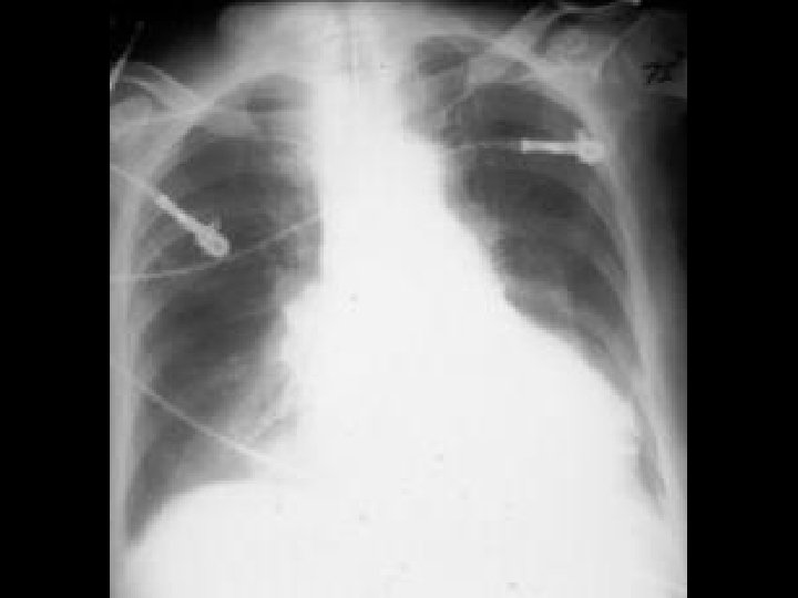 Right Ventricular Failure RVF Occurs when the right