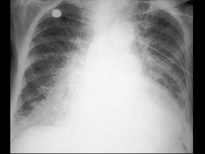 Right Ventricular Failure RVF Occurs when the right