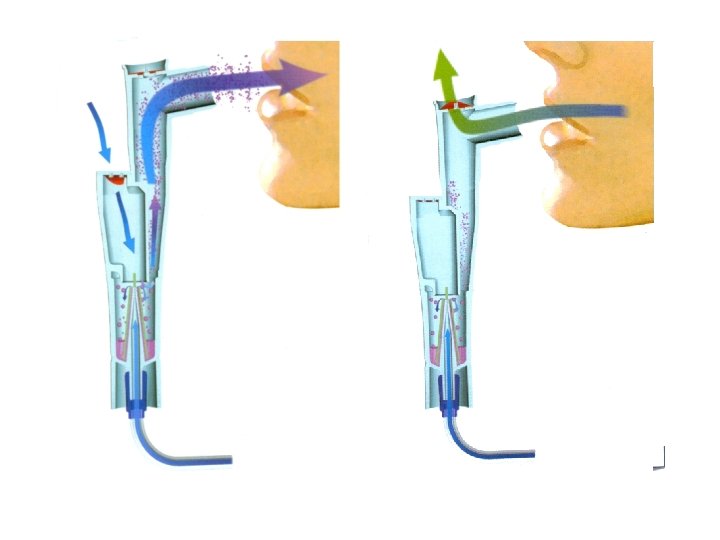 La terapia per via inalatoria in Pediatria Le