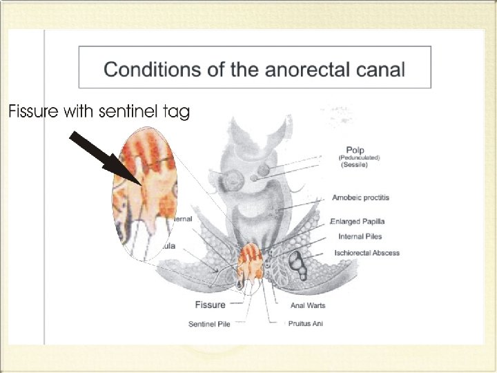 FISSURE IN ANO Definition It is a common