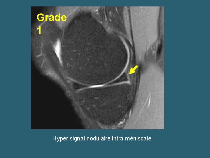 ATLAS IRM DES LESIONS MENISCO LIGAMENTAIRES DU GENOU