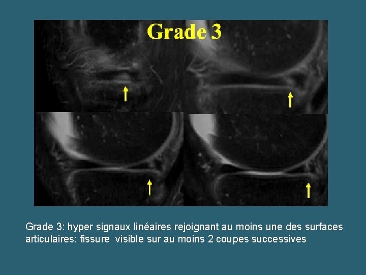 ATLAS IRM DES LESIONS MENISCO LIGAMENTAIRES DU GENOU