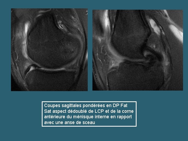 ATLAS IRM DES LESIONS MENISCO LIGAMENTAIRES DU GENOU