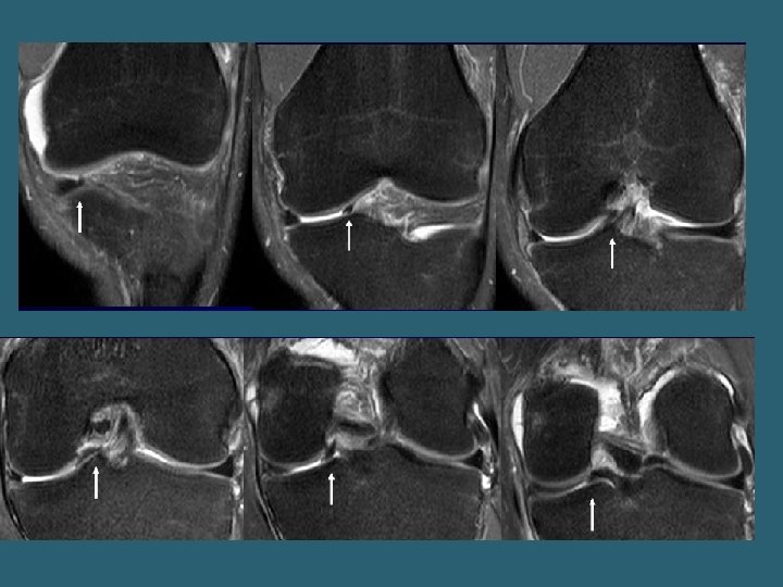 ATLAS IRM DES LESIONS MENISCO LIGAMENTAIRES DU GENOU
