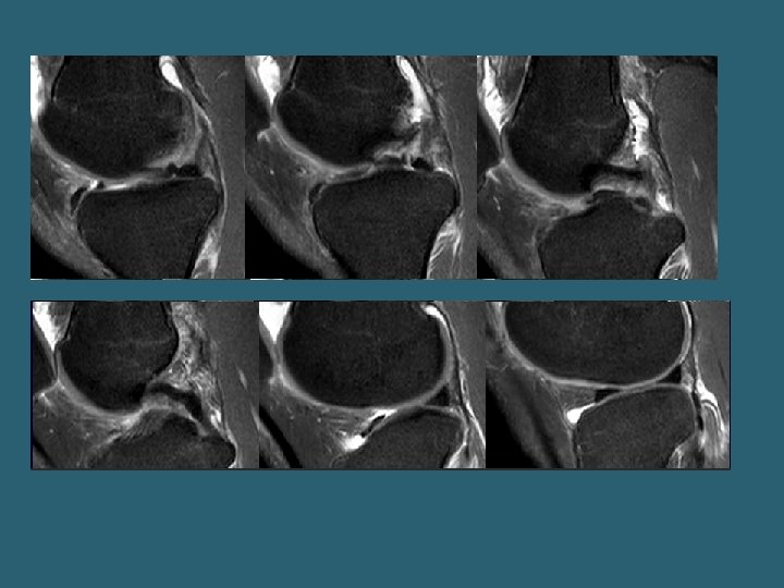 ATLAS IRM DES LESIONS MENISCO LIGAMENTAIRES DU GENOU