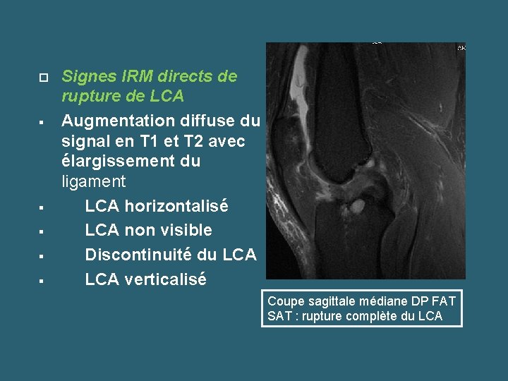 ATLAS IRM DES LESIONS MENISCO LIGAMENTAIRES DU GENOU