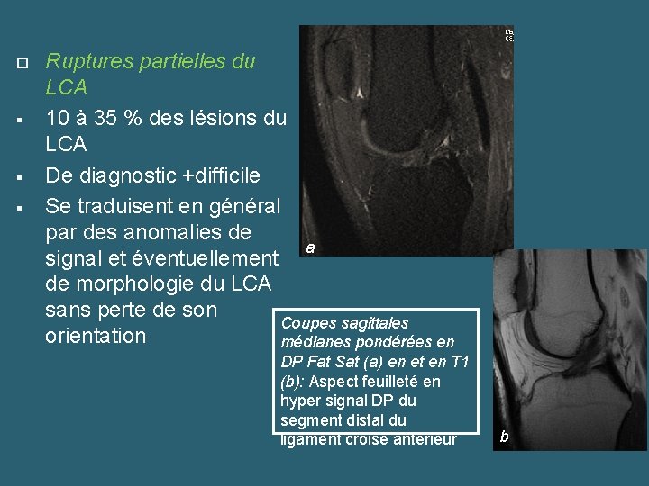 ATLAS IRM DES LESIONS MENISCO LIGAMENTAIRES DU GENOU