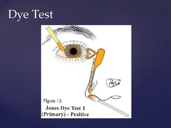 NASOLACRIMAL DUCT INJURY Oleh Betha Egih Riestiano Pembimbing