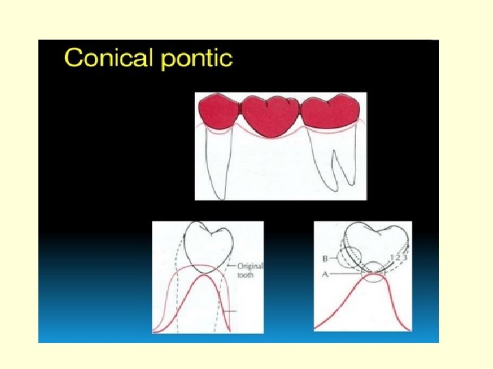 PONTICS A fixed dental prosthesis which cannot be
