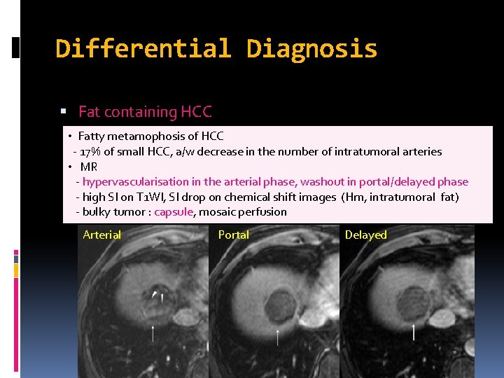 Differential Diagnosis Fat containing HCC Fatty metamophosis of